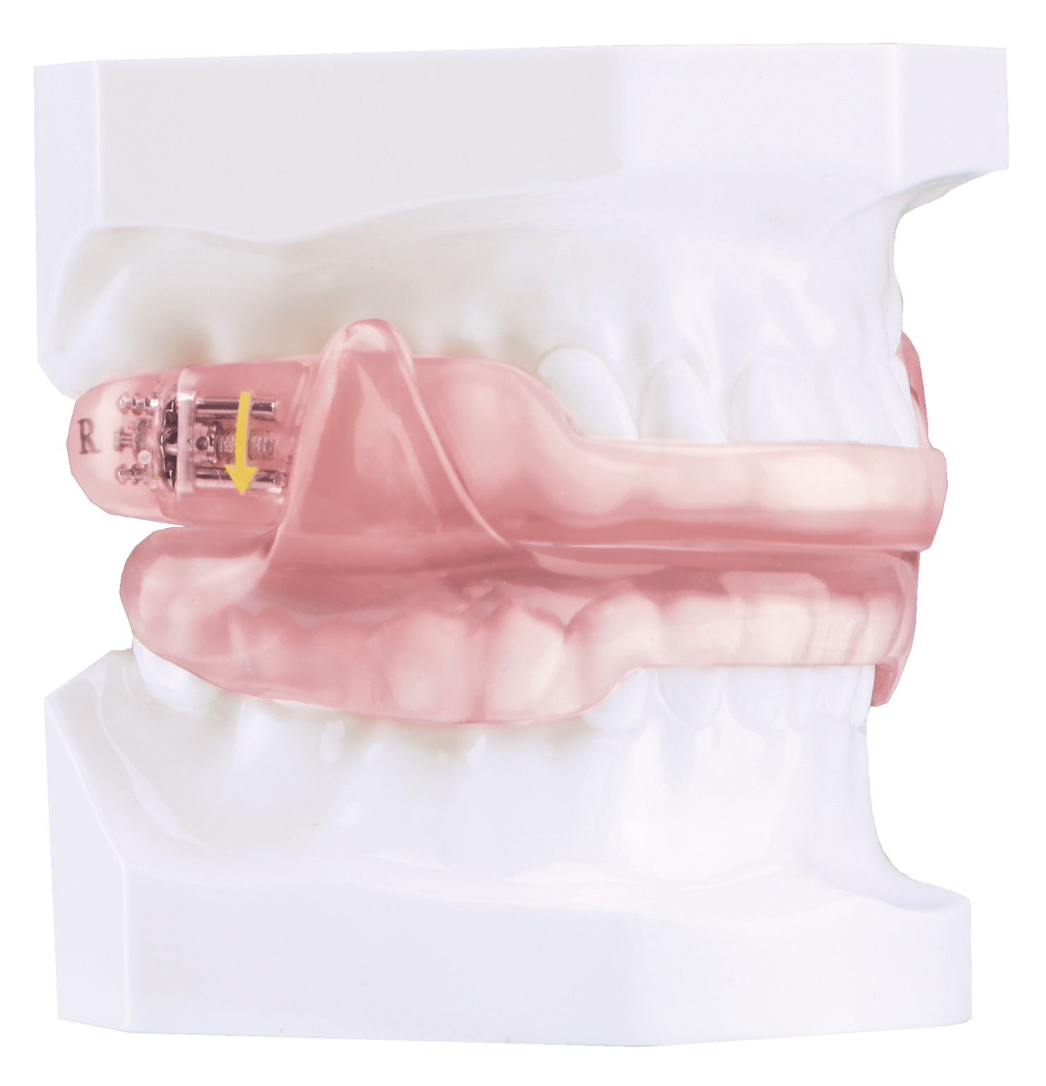 CPAP Alternatives for Sleep Apnea St. Louis MO | Oral Appliance Therapy
